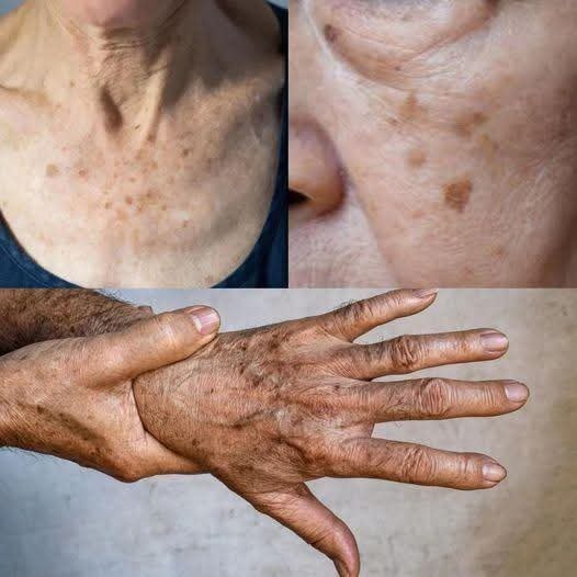 Cómo Eliminar Las Manchas Y Blanquear La Piel En Casa - Todo sobre Remedios